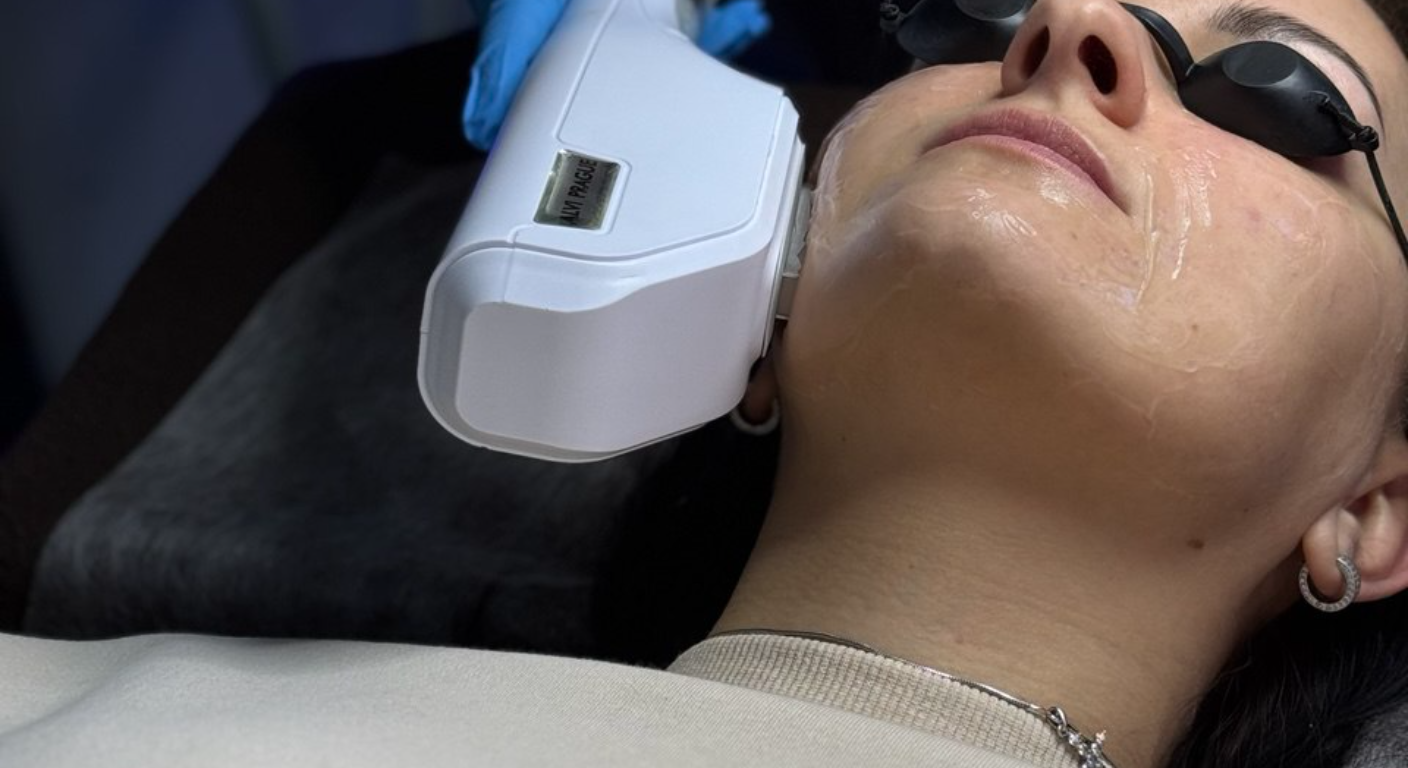 IPL лікування судинних зірочок, куперозу, розацеа - Laser Hall